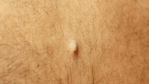 Traitement du kyste pilonidal au laser - Clinique Saint-Germain-en-Laye