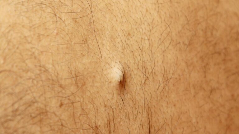Traitement du kyste pilonidal au laser - Clinique Saint-Germain-en-Laye